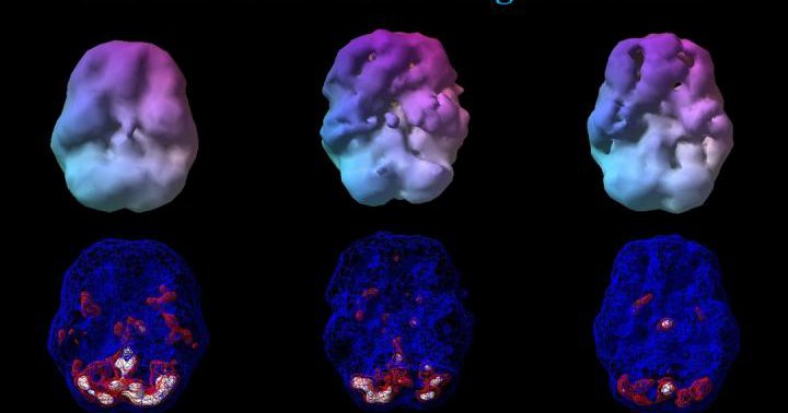 Obesity reduces blood flow to the brain, increasing risk to Alzheimer's ...