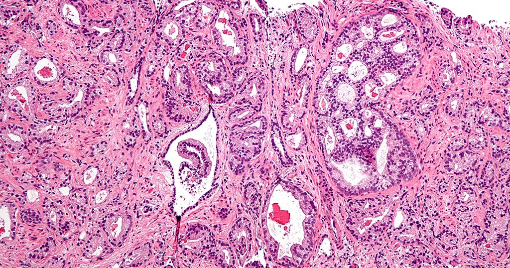 Doctors have developed a more accurate screening for prostate cancer ...