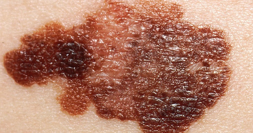 An at-home skin cancer test is being tested by University of Michigan ...