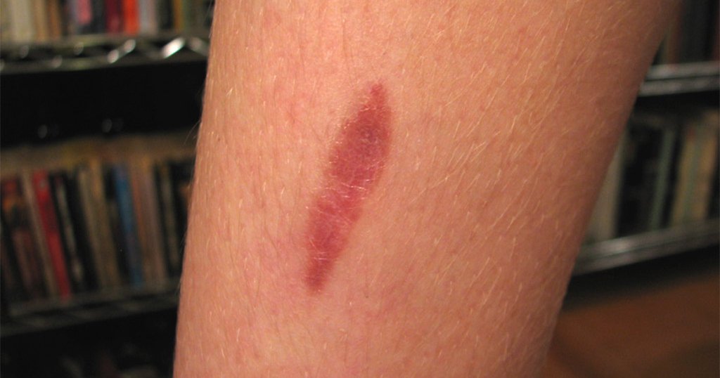 Why older skin heals with less scarring | PhillyVoice