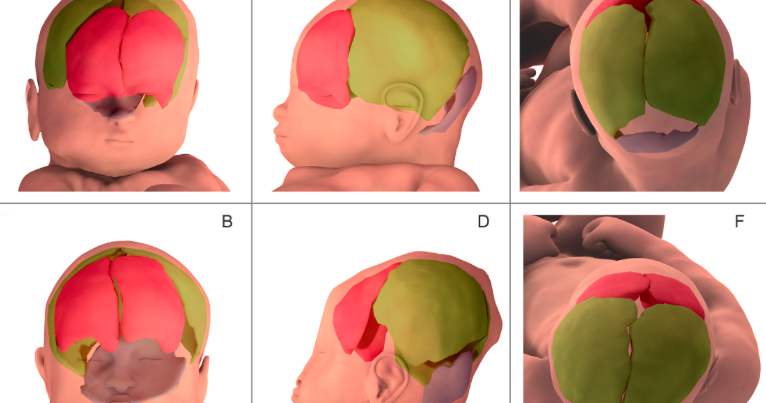 3D images show how much babies' heads get squished during birth ...